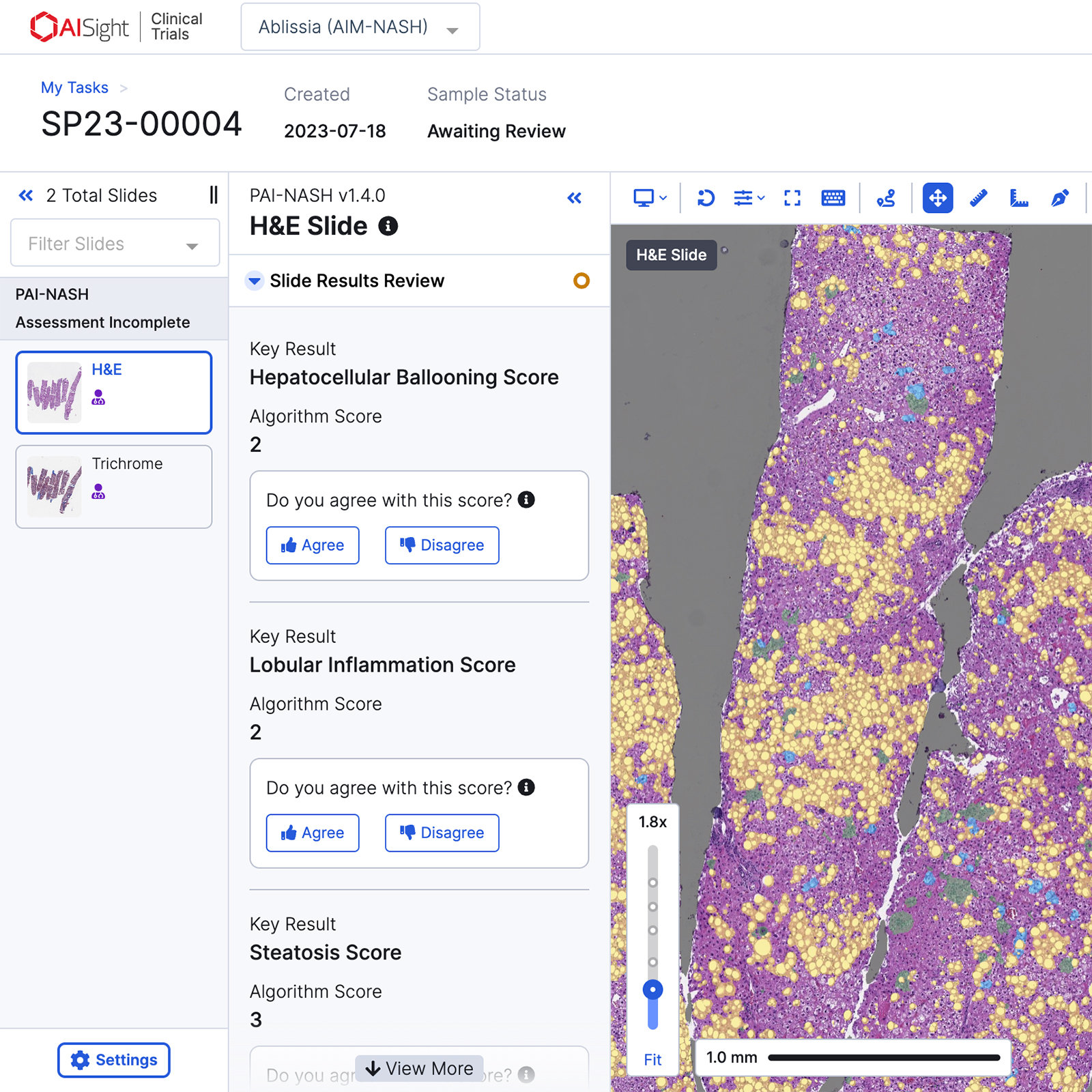 AI-based MASH Scoring