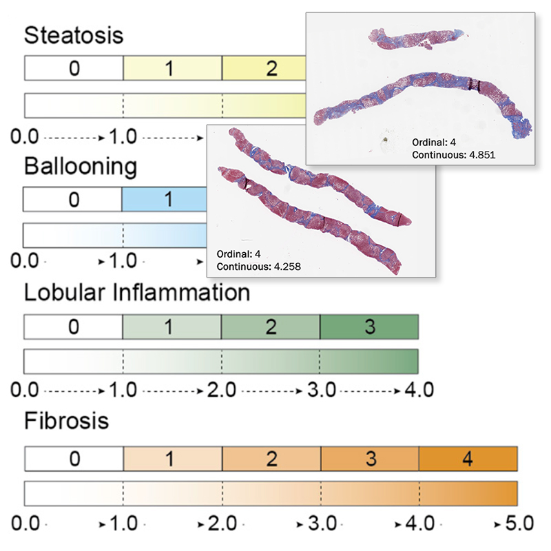 AI-based MASH Scoring